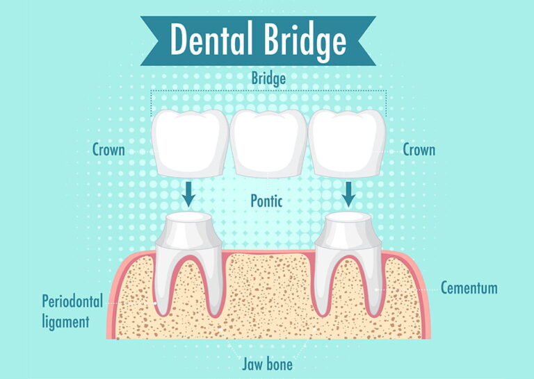 What does a Dental Bridge Look Like? – Prime Dentistry