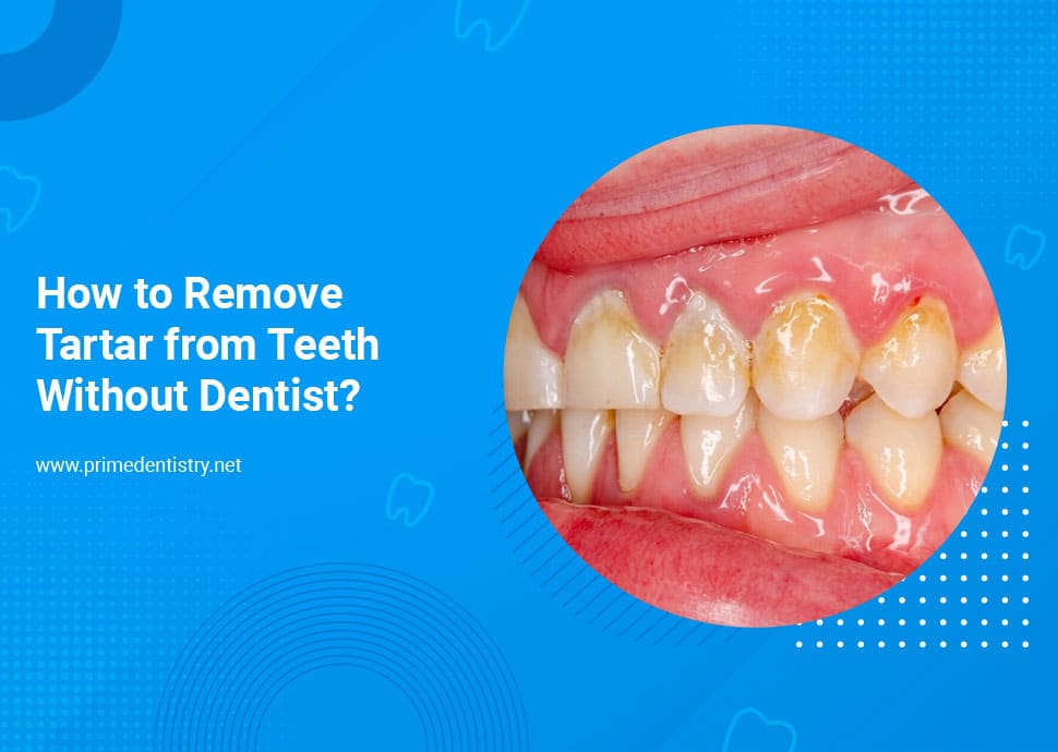 How to Remove Tartar from Teeth Without Dentist? – Prime Dentistry